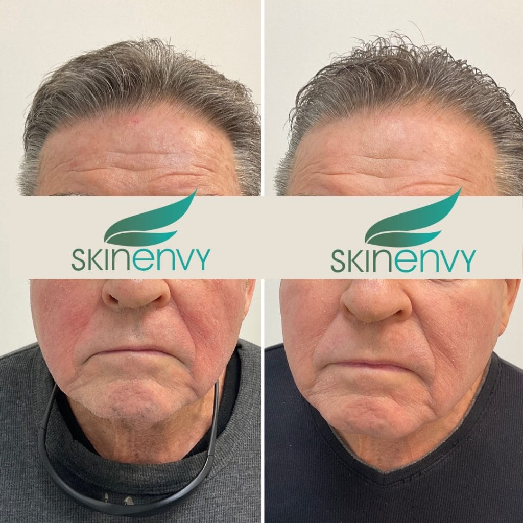 Laser Genesis Treatment In Brooklyn, NY | Skin Envy